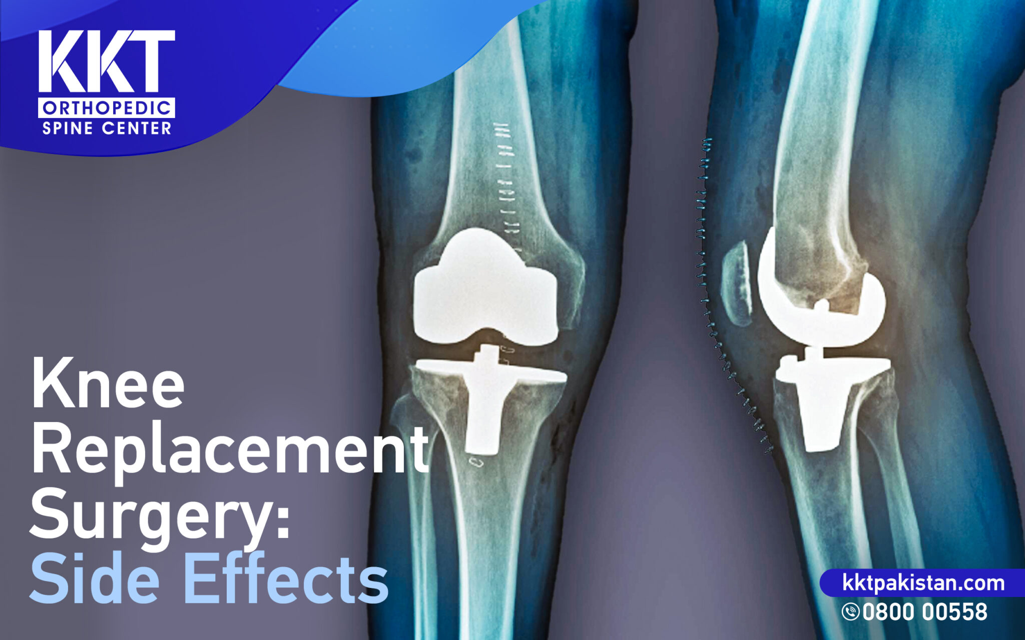 Knee Replacement Surgery: Side Effects – KKT Orthopedic Spine Center