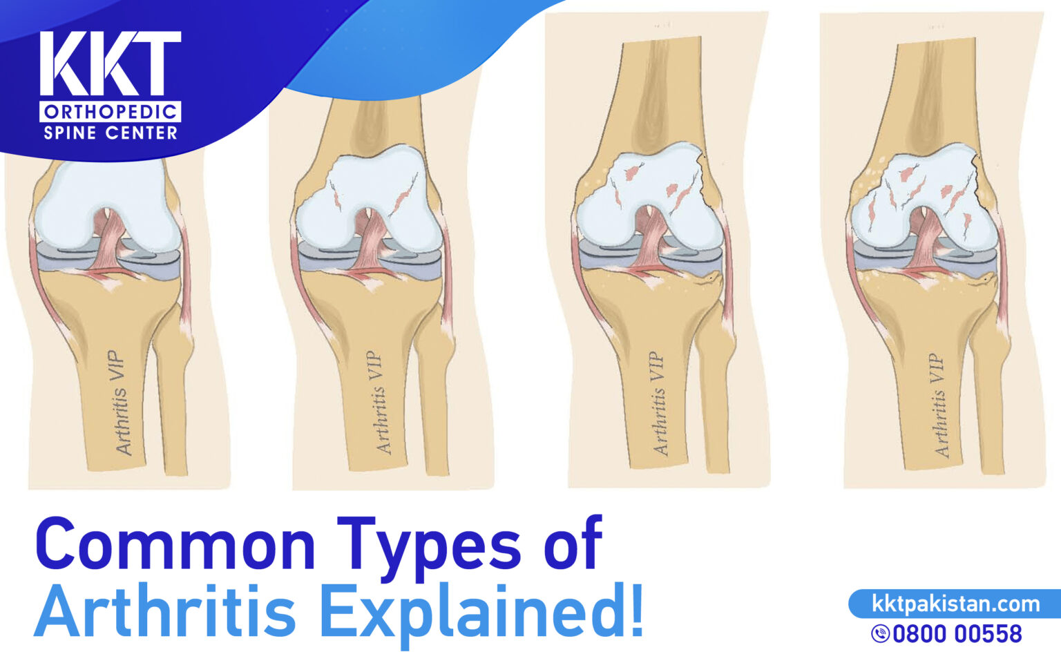 Common Types of Arthritis Explained! – KKT Orthopedic Spine Center